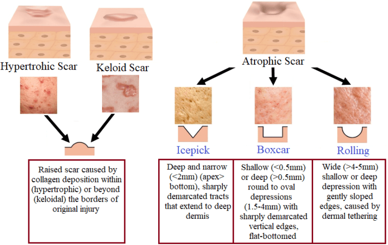 Understanding Acne Scarring: Types and Treatment Options - Premier Skin ...
