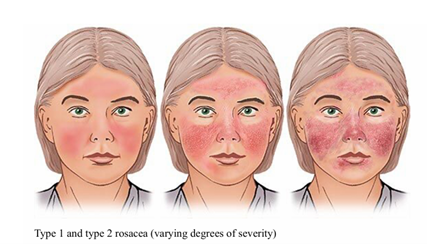 Rosacea: Understanding the Condition, Subtypes, and Treatment Options ...