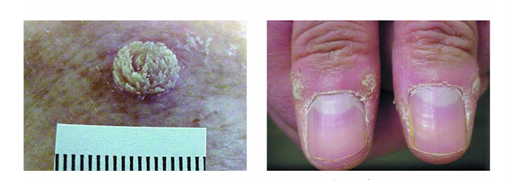 Skin Warts: Understanding, Treating, and Prevention - Premier Skin ...