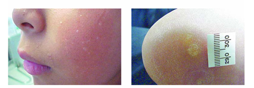 Skin Warts: Understanding, Treating, and Prevention | Premier Skin ...